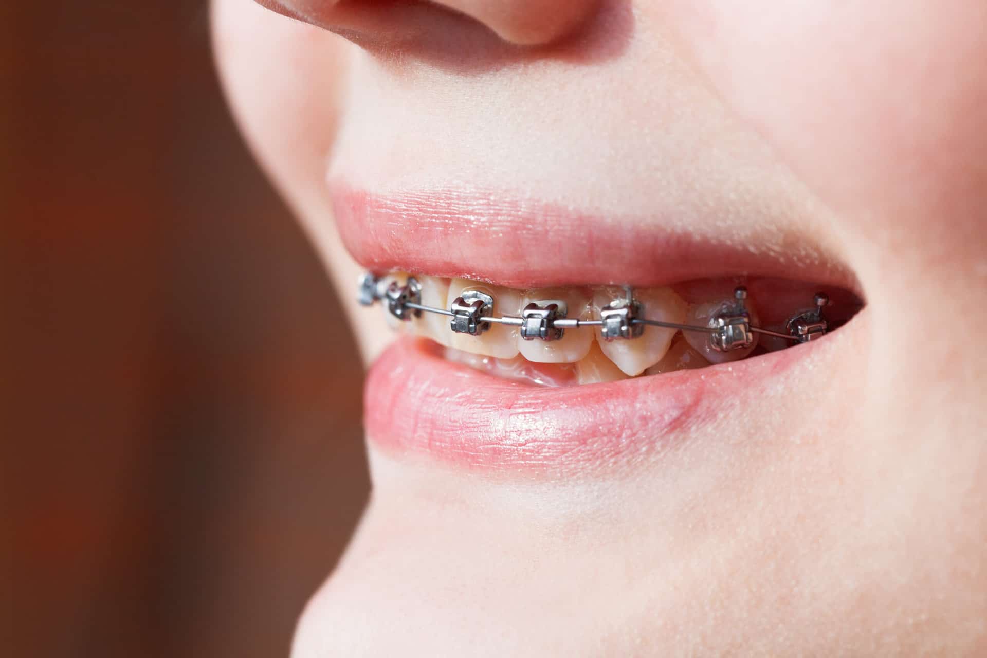 Metal Braces in Fort Collins and Loveland, CO - Timberline Smiles