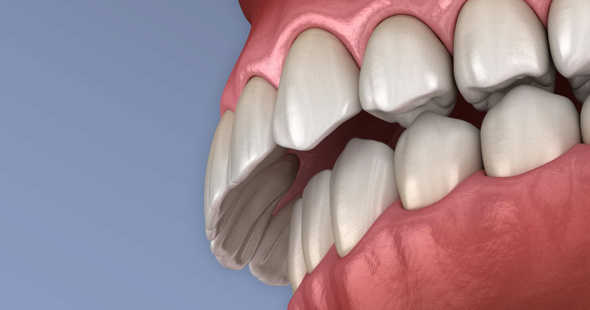 Overbite Treatment in Fort Collins & Loveland, CO